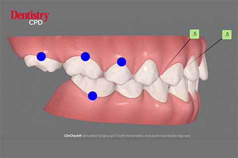 Dentistry Cpd Growth Modification Treatment In Class Ii Malocclusion