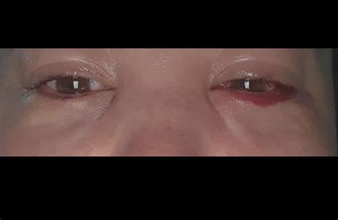 Im 37 And Got A Lower Bleph 10 Days Ago Heres My Experience R