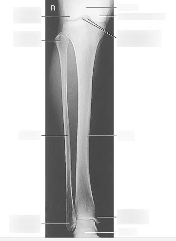 Tib Fib AP Radiograph Diagram Quizlet