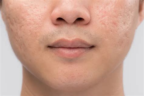 Acne Scars Treatment Fairview Dermatology