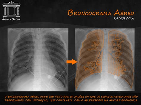 Broncograma Aéreo Raio X Retoedu
