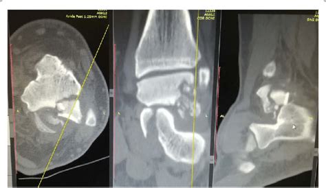 Ankle Ct Scan Showing Lateral Talar Process Fracture With Comminution