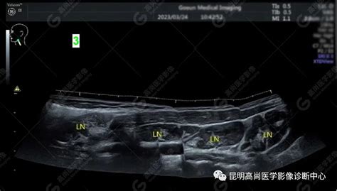 高尚病例：一针辨真伪——超声引导下颈部淋巴结穿刺活检 1 例 医院汇 丁香园
