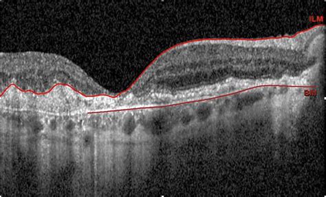 New Horizons In Vision Enhancement New Retinal Physician