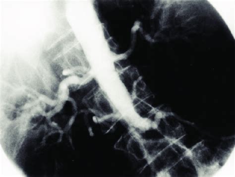An Abdominal Aortogram Showing Total Occlusion Of The Bilateral Common Download Scientific