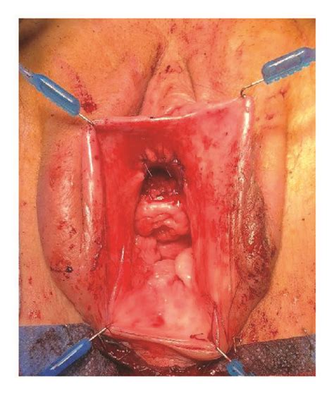 Dorsal Onlay Buccal Mucosa Graft Urethroplasty A Semilunar Dorsal