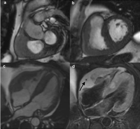 Primary Cardiac Lymphoma A Balanced Steady State Gradient Recall Echo