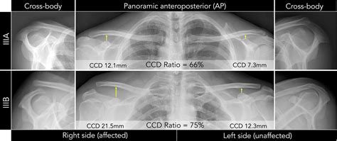 Rockwood Classification Of Acromioclavicular Joint Injuries Download