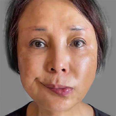 The Global Aesthetic Improvement Scale Download Scientific Diagram