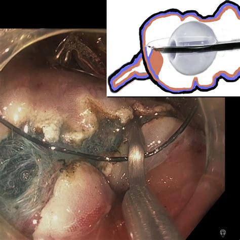 Anulocytes White Arrows Hemo O Lok Day 28 Th Download Scientific