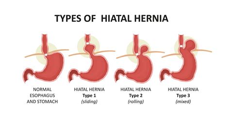 Everything To Know About A Hiatal Hernia
