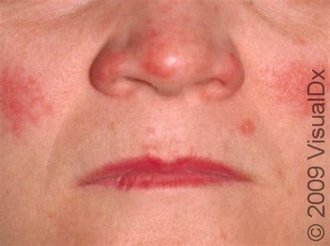 Nasal Sores Lupus
