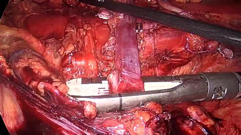 Laparoscopic Donor Nephrectomy By Stuart Geffner Md Jandj Medtech