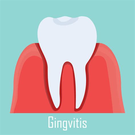 Gingivitis Goma Enfermedad Aislado Ilustración Será Diente Dental