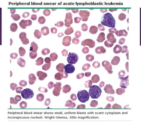 Pediatric Cancers Flashcards Quizlet