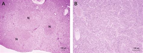 Preneoplastic And Neoplastic Lesions In The Liver A Hyperplastic