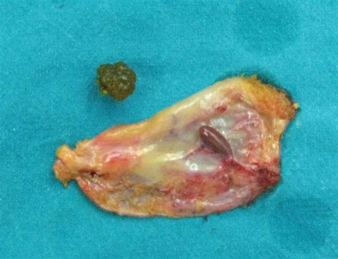 Surgical Specimen After Gallbladder Was Opened Shows The Mass Ectopic Download Scientific
