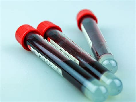 Hyperammonemia High Ammonia Levels And Whats Considered Normal