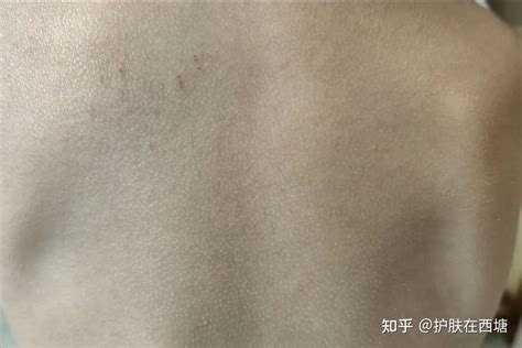鸡皮肤是毛周角化症吗？ 知乎