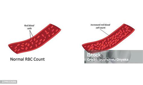 Ilustración De Ilustración Vectorial De Eritrocitosis Y Más Vectores