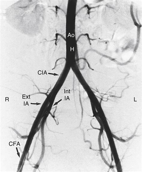 Vascular Anatomy Of The Pelvis Clinical Tree