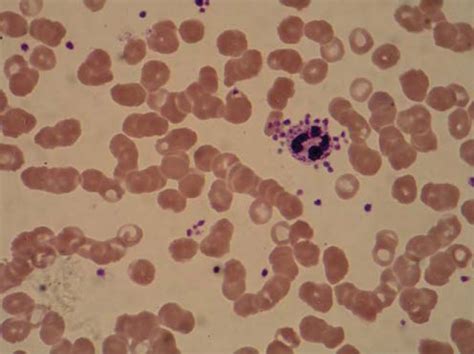 Platelet Satellitism In Edta Anticoagulated Blood Download