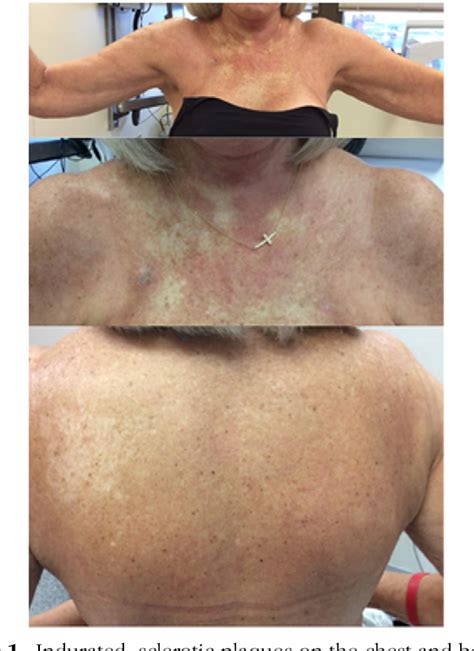 Figure 1 From A Case Of Nivolumab Induced Scleroderma Like Syndrome Successfully Treated With