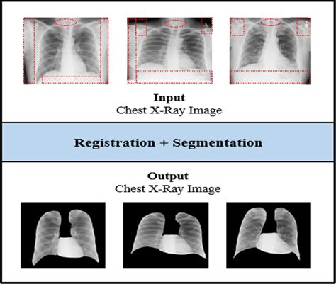 Structure Of ChestXRay14 Image Classification Network Model After