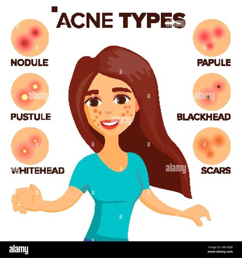 Types Of Acne Nodules
