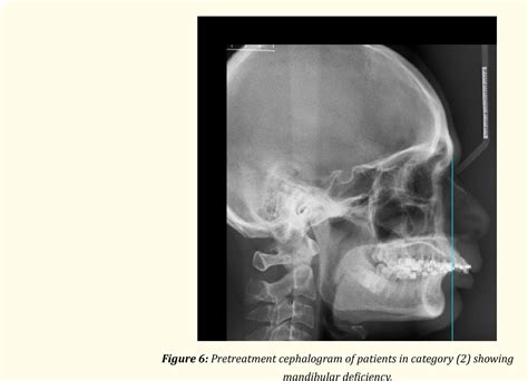 Skeletal Class Ii Malocclusion