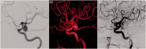 Pipeline Embolization Device Deployment Via An Envoy Distal 49 Off