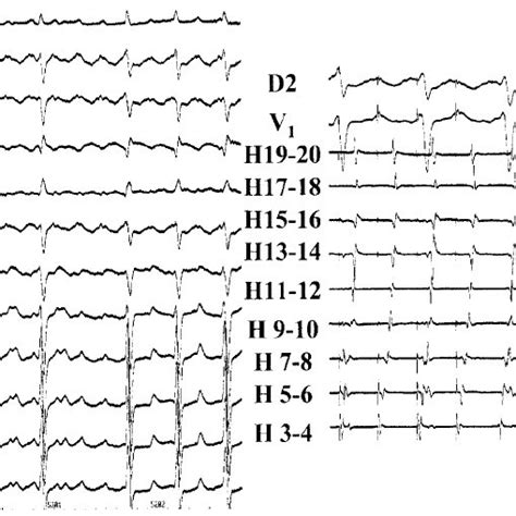 Left Atrial Flutter Left Panel Atypical Ecg With Sawtooth In The