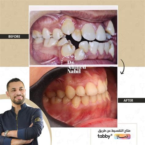 Pt Came Complaining From Sever Crowding In Both Arches With Class Iii