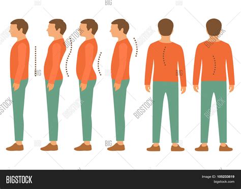 Scoliosis Lordosis Vector And Photo Free Trial Bigstock