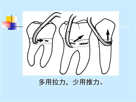 不得不知的治疗牙周炎的5种最有效方法! 好医术文章 好医术 赋能医生守护生命 不得不知的治疗牙周炎的5种最有效方法! 好医术文章 好医术 赋能医生守护生命