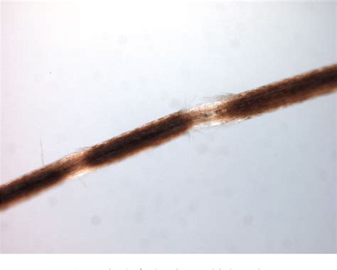 Figure 2 From A Case Of Acquired Trichorrhexis Nodosa After Applying New Hair Spray Semantic