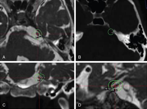 Trigeminal Neuralgia Due To Microvascular Conflict Upfront