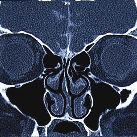 Anterior Ethmoidal Nerve From Frank H Netter Atlas Of Human Download Scientific Diagram