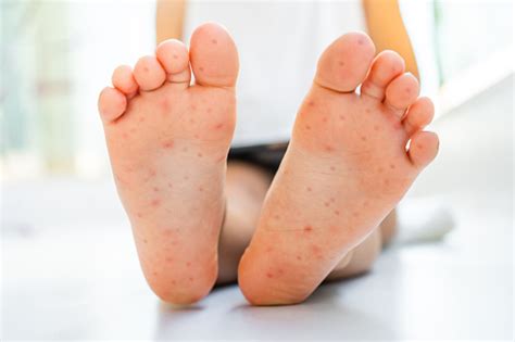 엔테로 바이러스 다리 팔 입 아이의 몸에 발진 콕사키 바이러스 입에 대한 스톡 사진 및 기타 이미지 입 수족구병 아이
