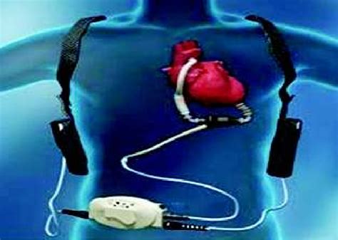 Left Ventricular Assist Device Lvad Download Scientific Diagram