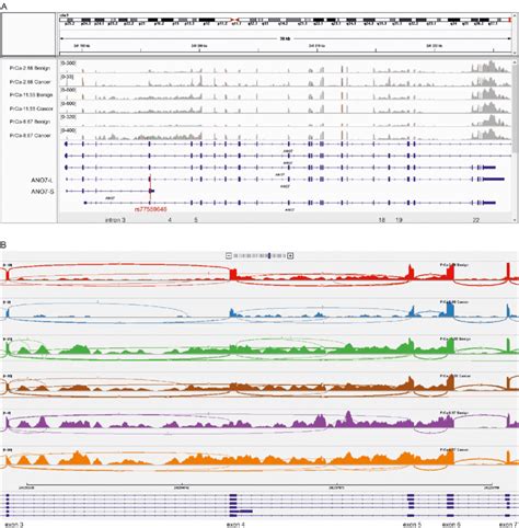 Rna Seq From Prostate Tissue Reveals Aberrant Rna Splicing In The Exons Download Scientific