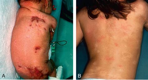 Aplasia Cutis Congenita Scalp Vertex Cutis Aplasia Temporal Triangular Alopecia Clinical Tree