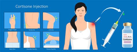 Cortisone Injections Vs Viscosupplementation Indications Benefits