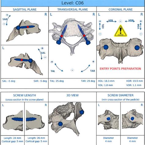 Planning Report For One Cervical Level C6 Download Scientific Diagram