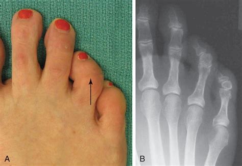 Lesser Toe Deformities Clinical Tree