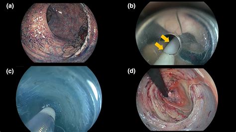 Trans‐anal Tube Facilitates Endoscopic Submucosal Dissection Of A 10