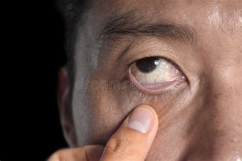 Anemia Skin Color