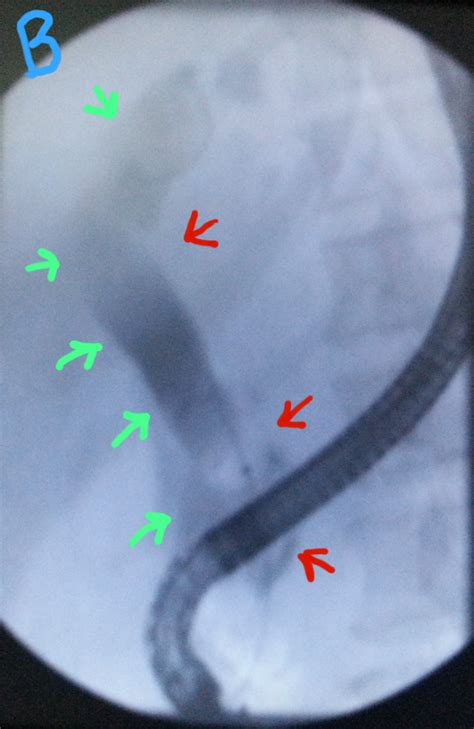 ERCP EGD Multiple CBD Stones Requiring Different Removal Techniques