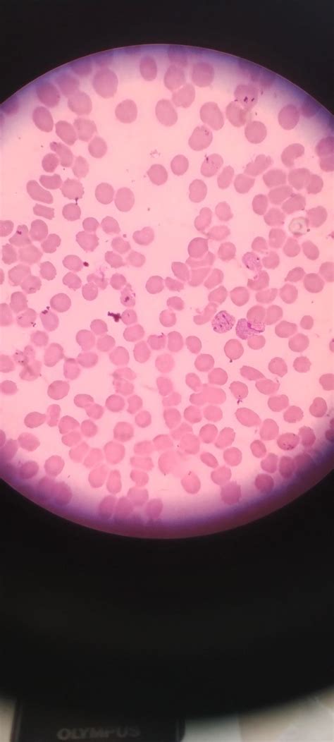 Gametocytes Of Plasmodium Vivax Shravan Kumar