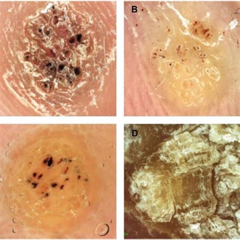 Different Patterns Of Plantar Warts Under The Dermoscope A Frogspawn Download Scientific